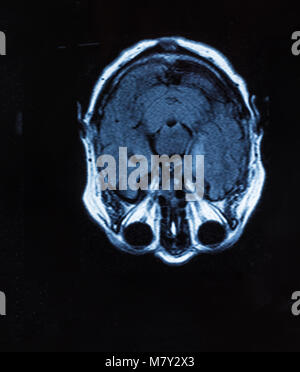 Head MRT. MR image of human brain Stock Photo - Alamy