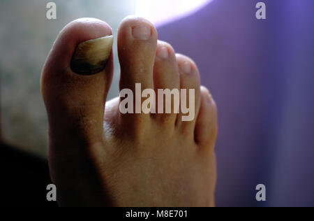 Damaged and cracked toenail. Fungal nail infection. Onychomycosis, also ...