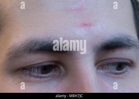 Raised red bumps and blisters caused by shingles on skin Stock Photo ...