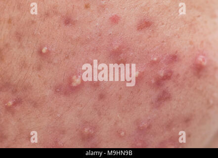 closeup skin problems, nodular cystic acne skin Stock Photo - Alamy