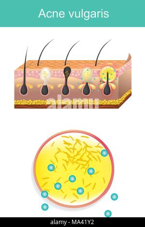 Formation of skin acne or pimple. The sebum in the clogged pore ...