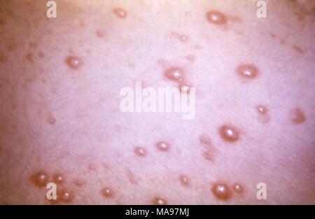 Herpesviridae chickenpox caused pustulovesicular rash on the skin due ...