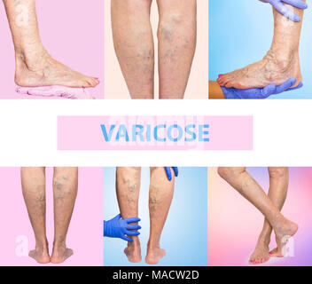 Painful varicose veins,,spider veins, varices on a female leg. Ageing ...
