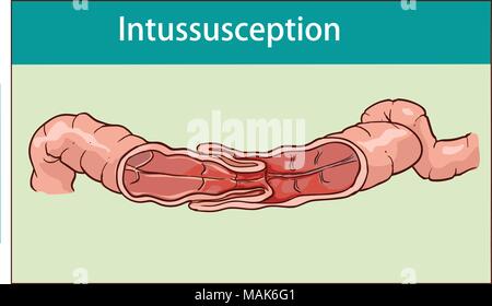vector illustration of intussusception of intestine. obstruction Stock ...
