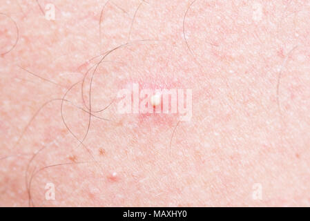 Close-up of a red abscess on the skin of the leg in a 6 year old female ...
