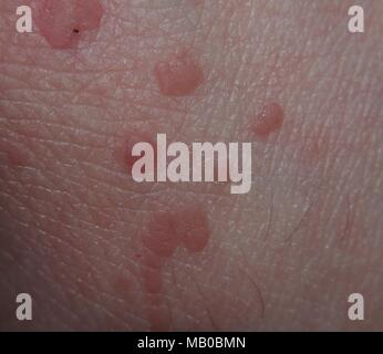 Close-up of common warts (verruca vulgaris) on the toe of a 22 year old ...
