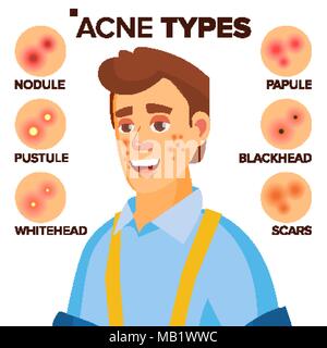 Types of Acne Skin inflammation. Pimples, boils, whitehead, closed ...