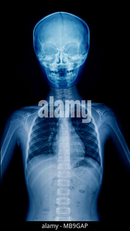 film x-ray skull and body of child ( blank area at left side Stock ...
