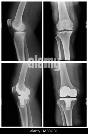 TKA x-ray, total knee replacement frontal and lateral view Stock Photo ...