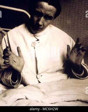 STIGMATA Portrait of Therese Neumann of Konnersreuth, with her tears of ...