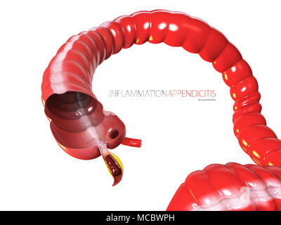 Appendicitis and appendix inflammation disease concept as a close up of ...