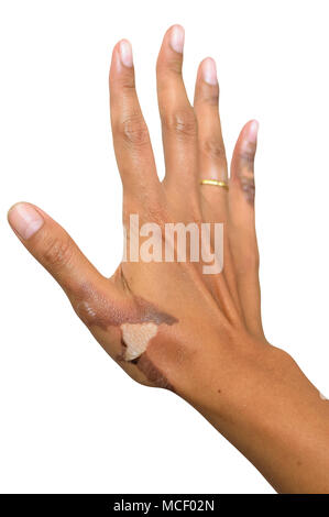 Horrible burns on female hand isolated on white Stock Photo - Alamy