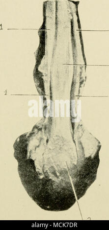 . Fig. 11.—The Flexor Perforans and Flexor Perforatus Tendons. The ...