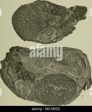 . Fig. 226—Orchitis and Epididymitis. T, Testicle ; E, epididymis ...