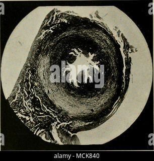 . Fig. 144--Chronic Catarrhal Salping:iti8. with a Distinct Crescent ...
