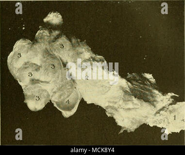 . Fig. 163—Complete Pelvic Adhesions with Uterus, Cornua, Oviducts, and ...