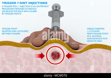 A trigger point injection is an outpatient procedure designed to reduce ...