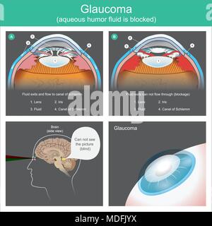 Anatomy of the Human Eye. Cornea (A), aqueous humor (B), iris (C ...