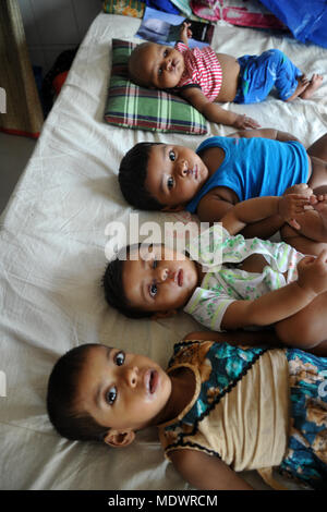 Birth defect baby boy with harelip in Dhaka medical college burn unit ...