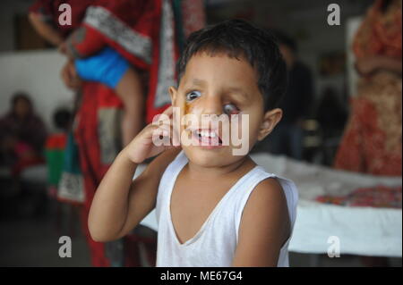 Birth defect baby boy with harelip in Dhaka medical college burn unit ...