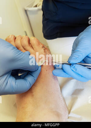 A nurse with blue surgical gloves removes stiches from the patients ...