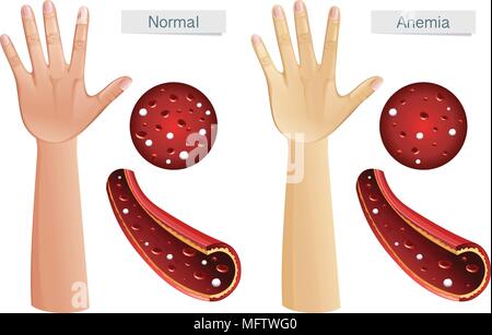 vector illustration of a Anemia diagram Stock Vector Image & Art - Alamy