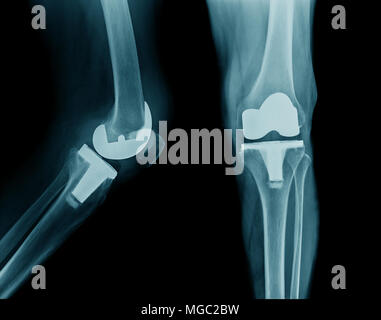 TKA x-ray, total knee replacement frontal and lateral view Stock Photo ...