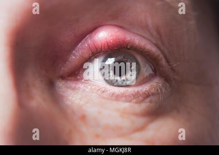 Infected sty barley purulent eye. Man pulls down lower eyelid showing ...