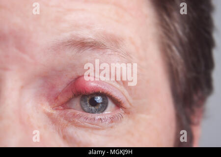 Infected sty barley purulent eye. Man pulls down lower eyelid showing ...