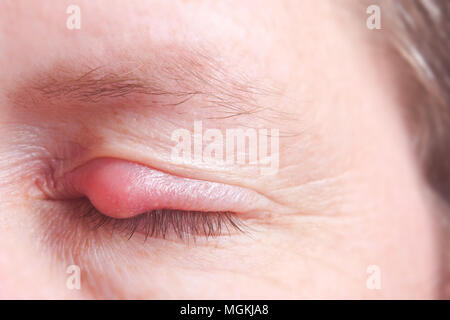 Infected sty barley purulent eye. Man pulls down lower eyelid showing ...