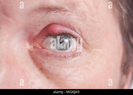 Infected sty barley purulent eye. Man pulls down lower eyelid showing ...