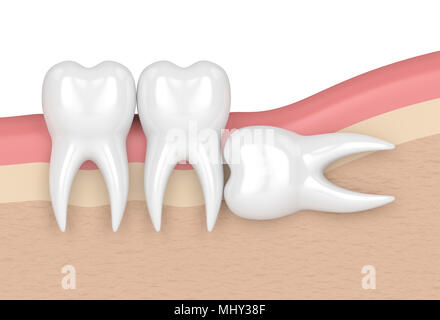 3d render of teeth with wisdom horizontal impaction. Concept of ...