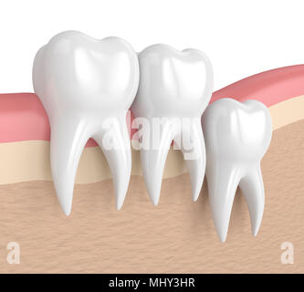 3d render of teeth with wisdom vertical impaction over white background ...