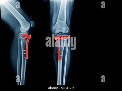 x-ray leg fracture with post operation internal fixation tibia bone ...