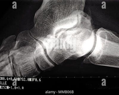 Normal ankle joint, X-ray Stock Photo - Alamy