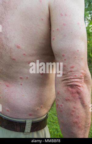 No-see-um bites, which caused itchy red welts, on Lee Rentz in ...