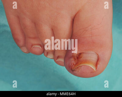 Inflamed big toe with ingrown toenail Stock Photo - Alamy
