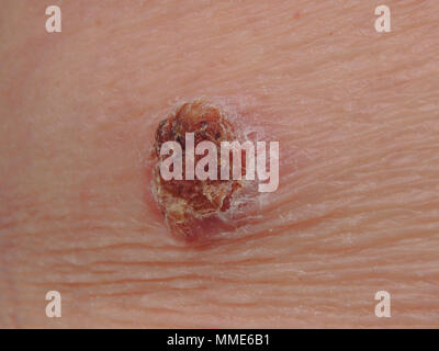 Bowen's disease. Close-up of a skin lesion due to Bowen's disease on ...