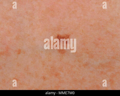 Close-up of a junctional naevus (mole) on the skin in a 28 year old ...