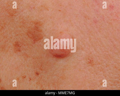 Intradermal naevus. Close-up of an intradermal naevus on a man's face ...