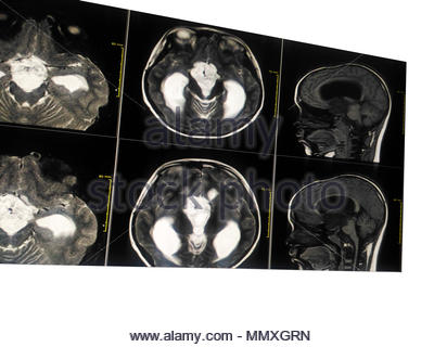 MRI brain : show brain tumor at right parietal lobe of cerebrum Stock ...