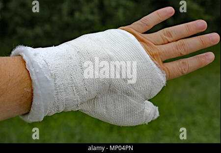 thumb of the fractured hand of the injured with the white medical cast ...