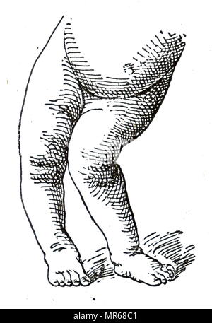 Illustration depicting the affects of Rickets of a boy aged 3, showing ...