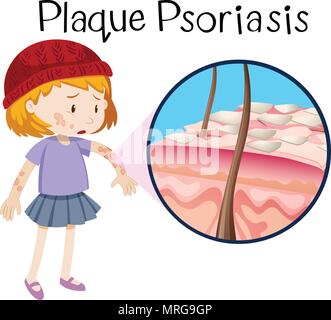 Human Anatomy of Plaque Psoriasis Stock Vector Image & Art - Alamy