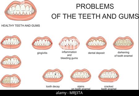 Human gum disease, gums bleeding. tooth disease prevention dental, oral ...