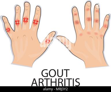 the mechanism of development of gout. pain in the joints Stock Vector ...