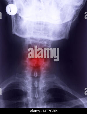 X-ray of neck, frontal projection. Cervical sprain rectification of ...