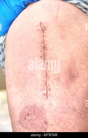 Replacing of the devastated hip joint for the hip endoprosthesis ...