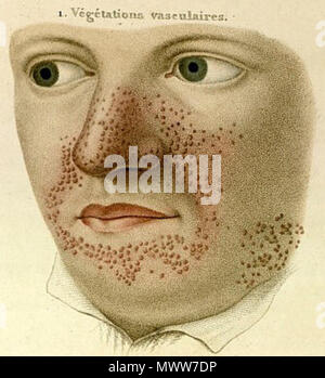 . English: The earliest illustration of tuberous sclerosis, with ...