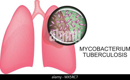 Scientific medical illustration of tuberculosis illustration Stock ...